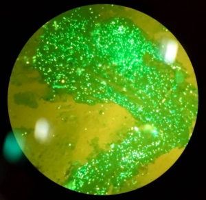 Despre spută, examenul sputei și cum identifică bolile respiratorii ...