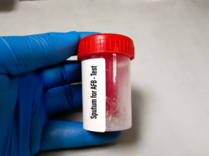 Despre spută, examenul sputei și cum identifică bolile respiratorii ...