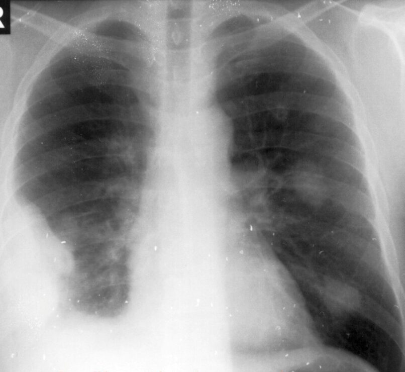 Pleureziile: ghid complet de la medicul specialist - Respira in siguranta