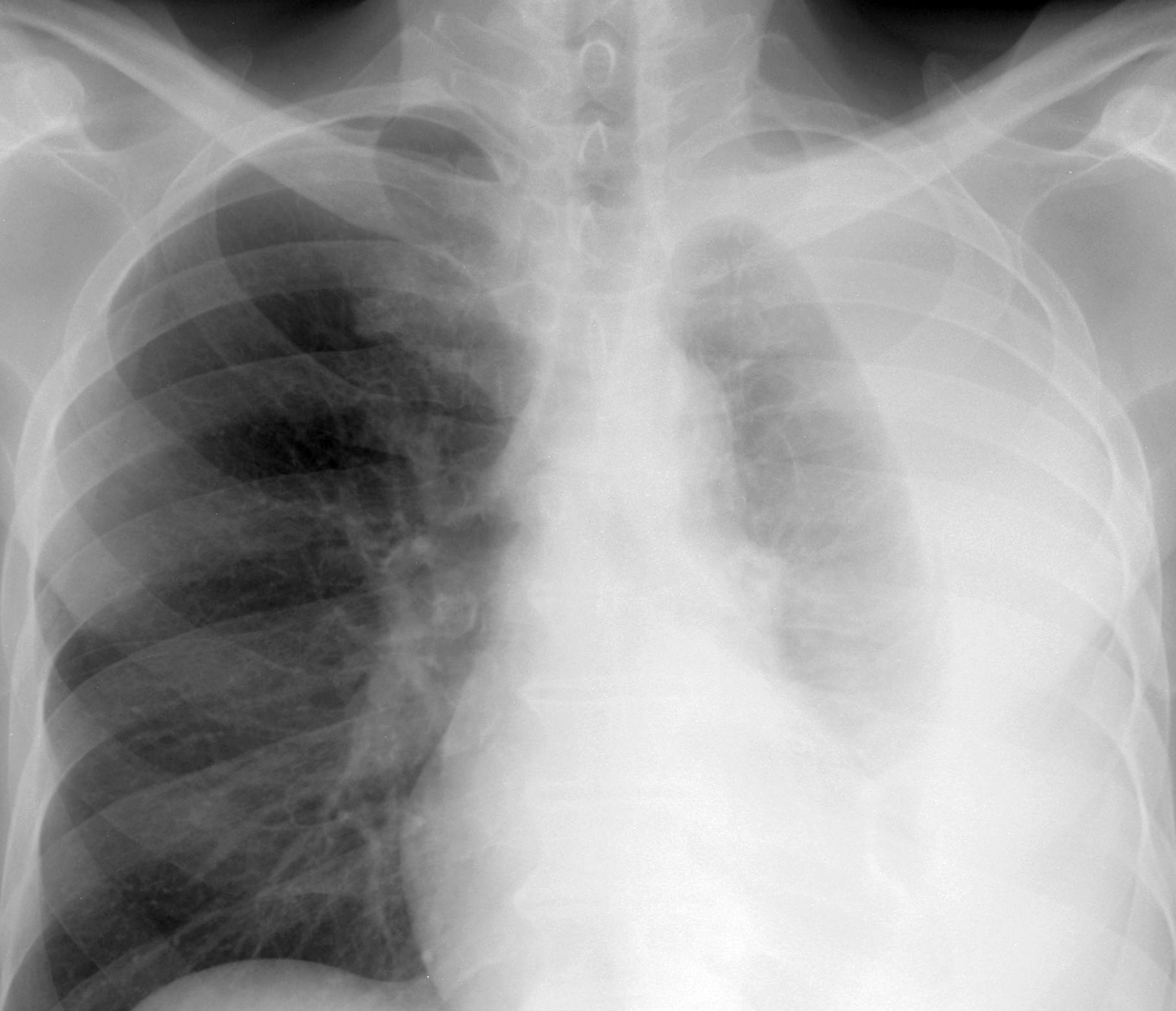 Pleureziile: ghid complet de la medicul specialist - Respira in siguranta