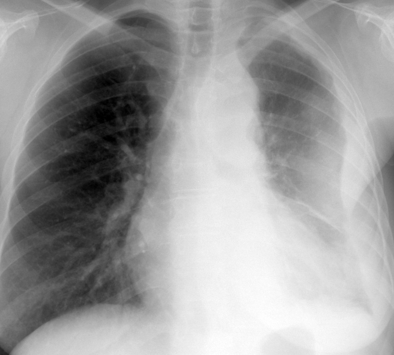 Pleureziile: ghid complet de la medicul specialist - Respira in siguranta