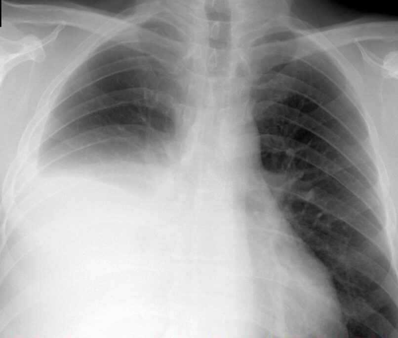 Pleureziile: ghid complet de la medicul specialist - Respira in siguranta