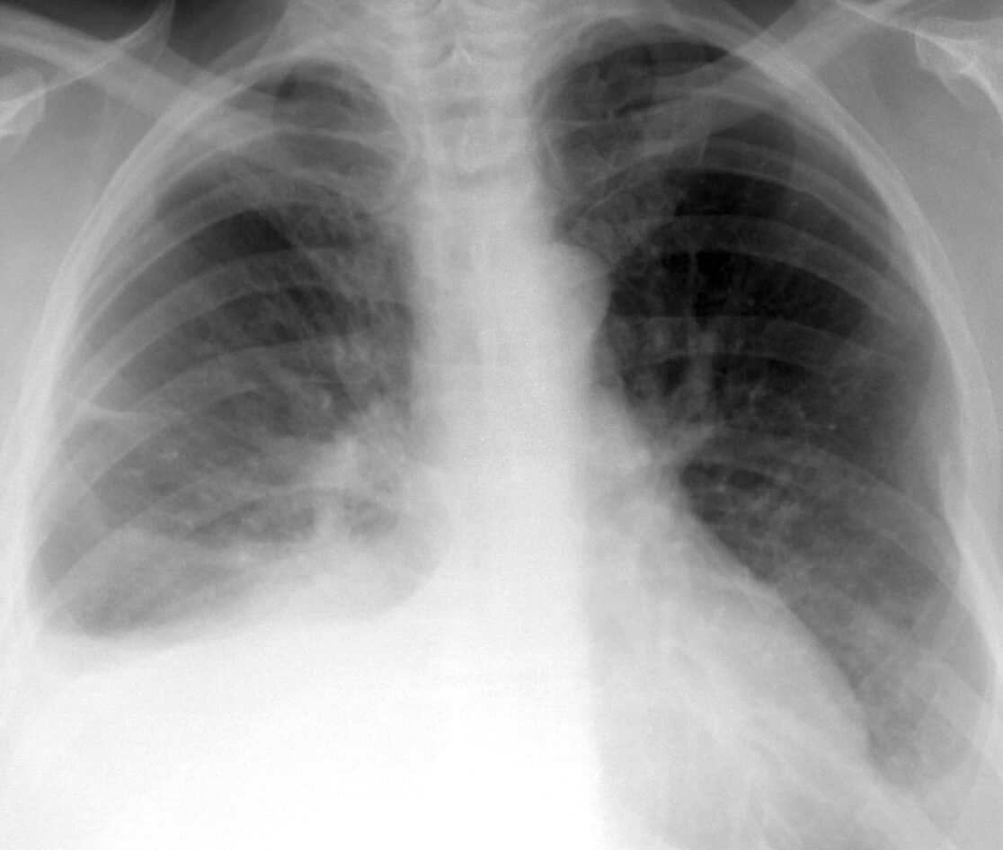 Pleureziile: ghid complet de la medicul specialist - Respira in siguranta