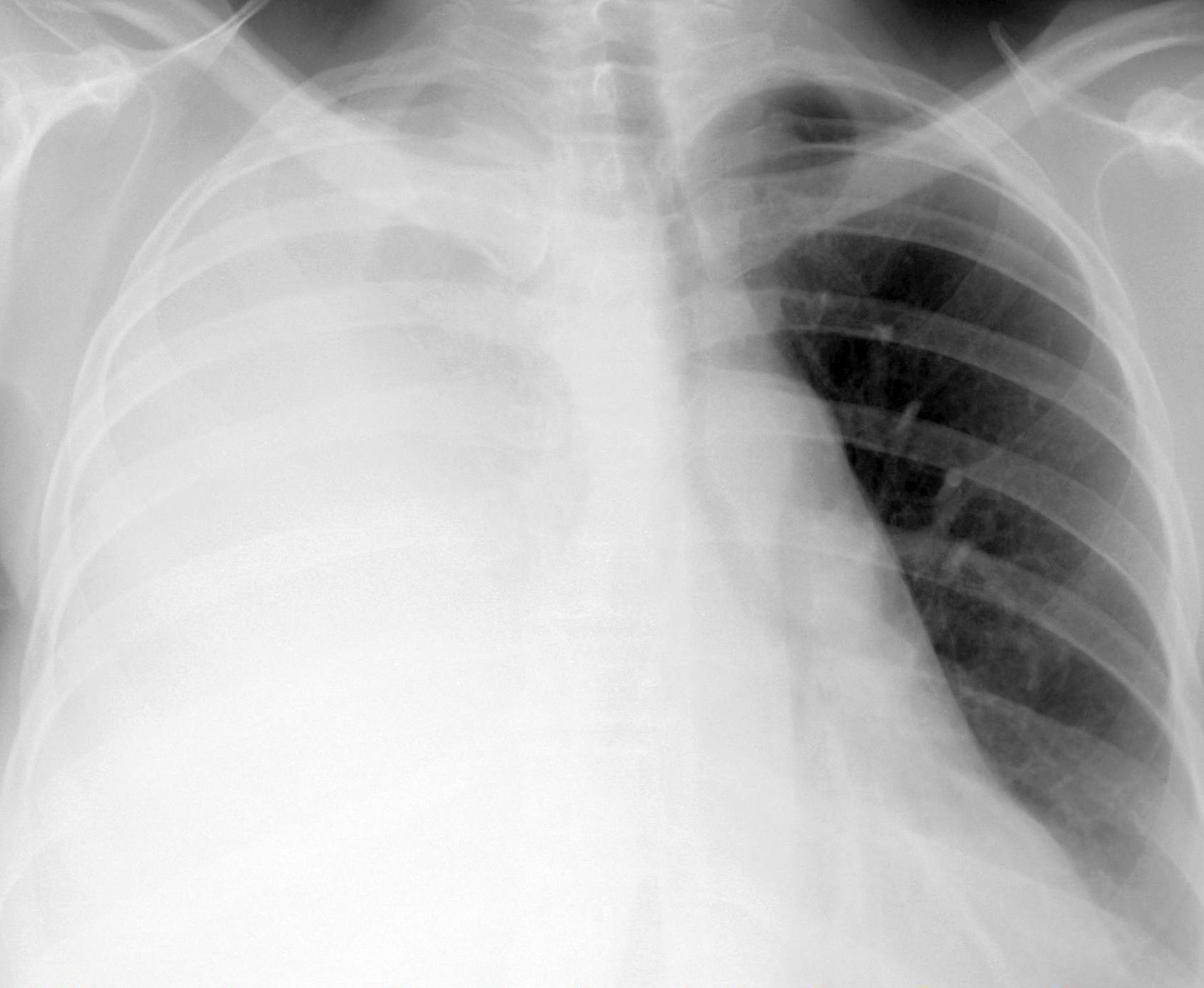 Pleureziile: ghid complet de la medicul specialist - Respira in siguranta