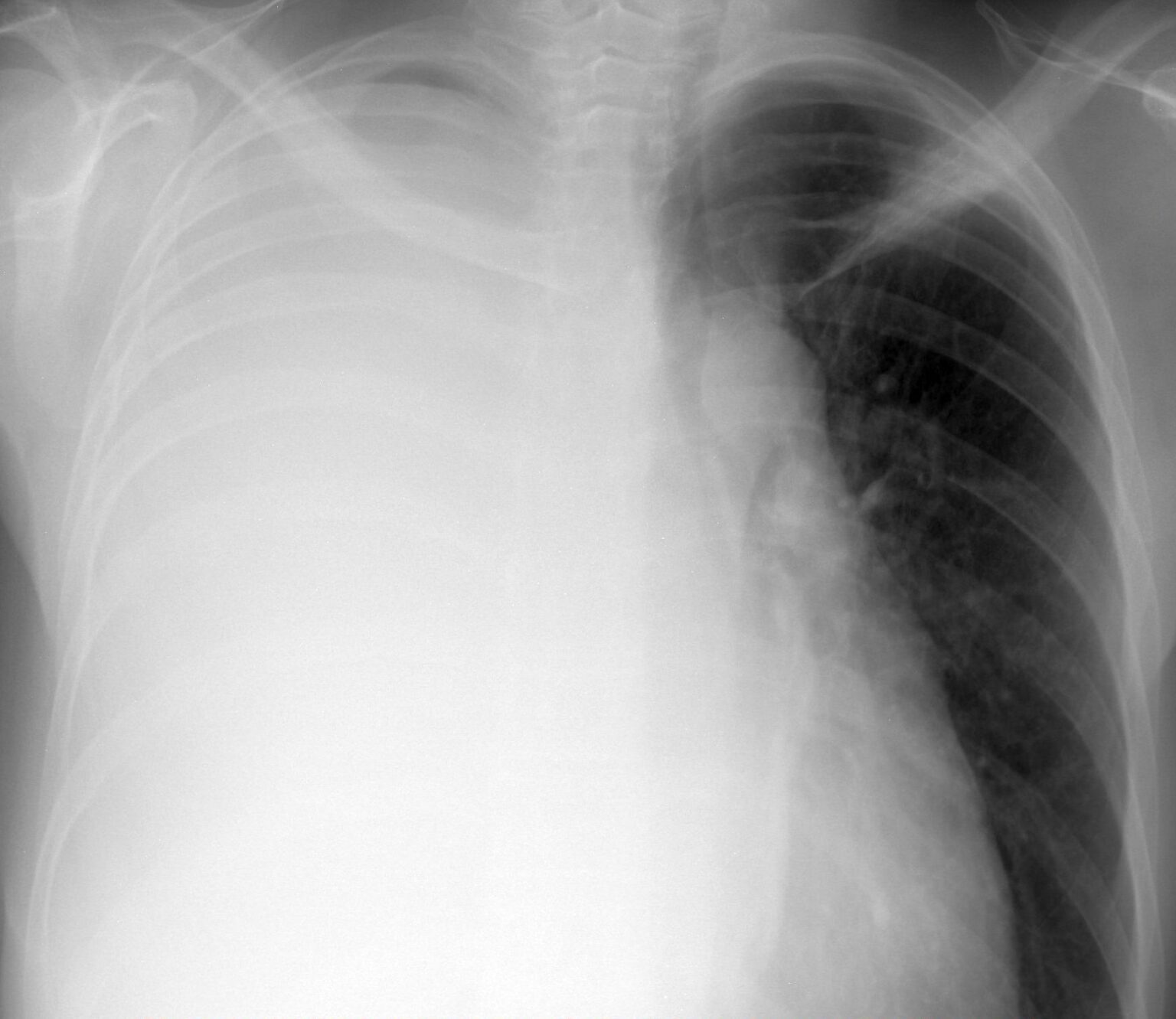 Pleureziile: ghid complet de la medicul specialist - Respira in siguranta