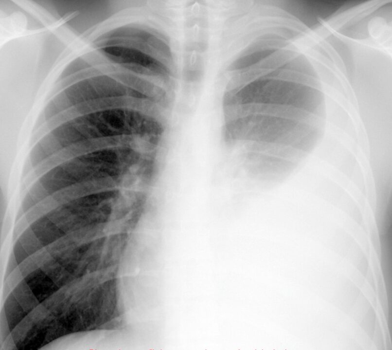 Pleureziile: ghid complet de la medicul specialist - Respira in siguranta