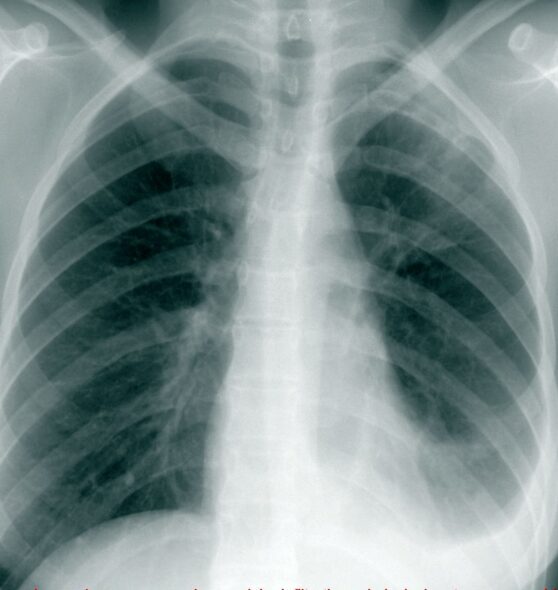 Pleureziile: ghid complet de la medicul specialist - Respira in siguranta