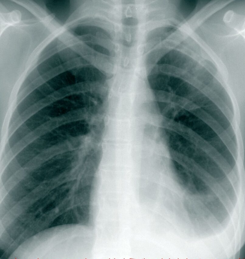 Pleureziile: ghid complet de la medicul specialist - Respira in siguranta