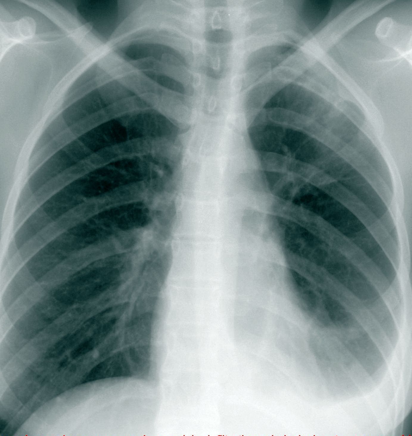 Pleureziile: ghid complet de la medicul specialist - Respira in siguranta